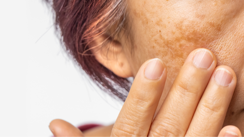 Macchie solari: come prevenirle e trattarle - Farmacia Ferretti Sas